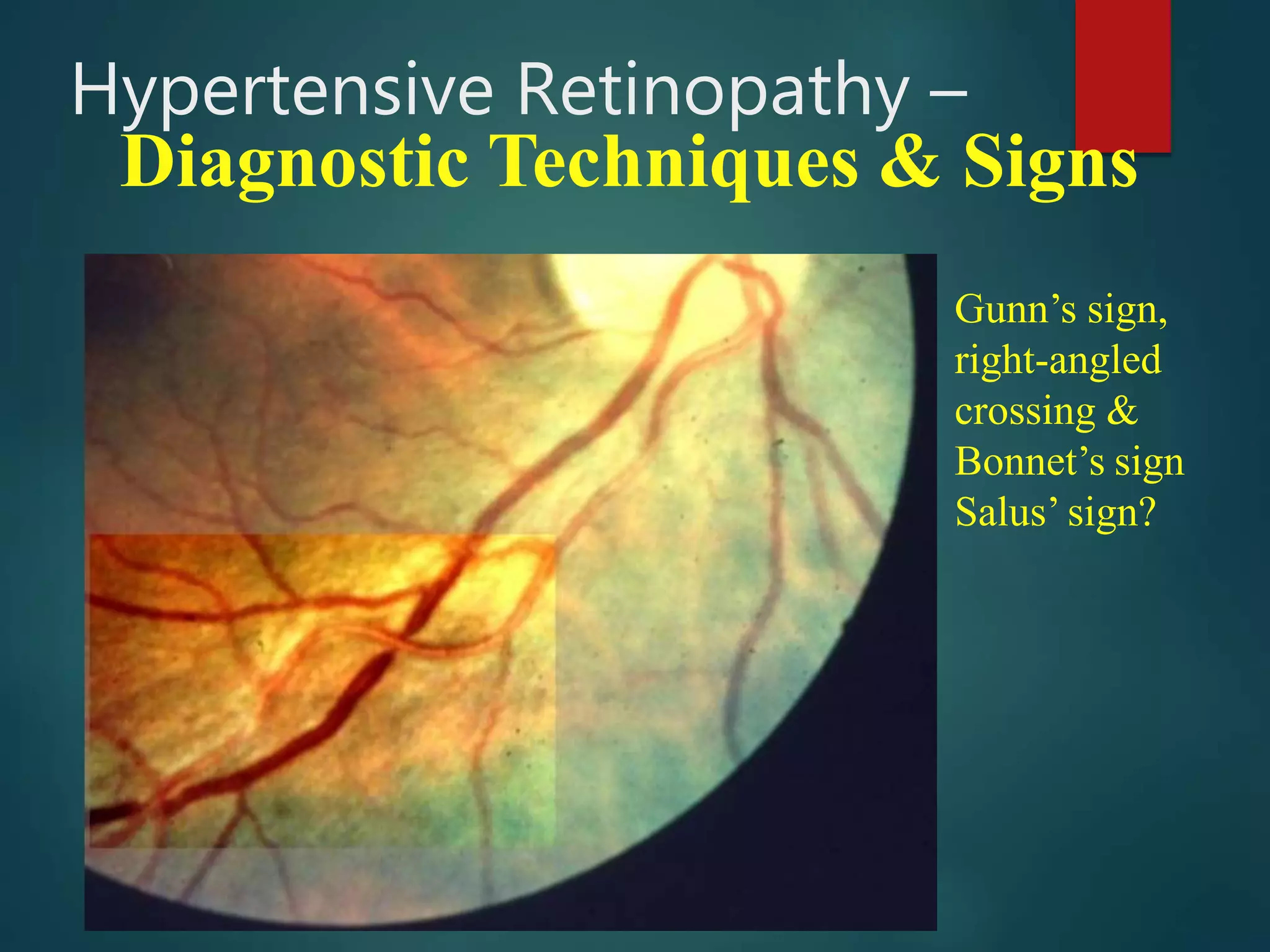 Hypertensive retinopathy converted | PPTX