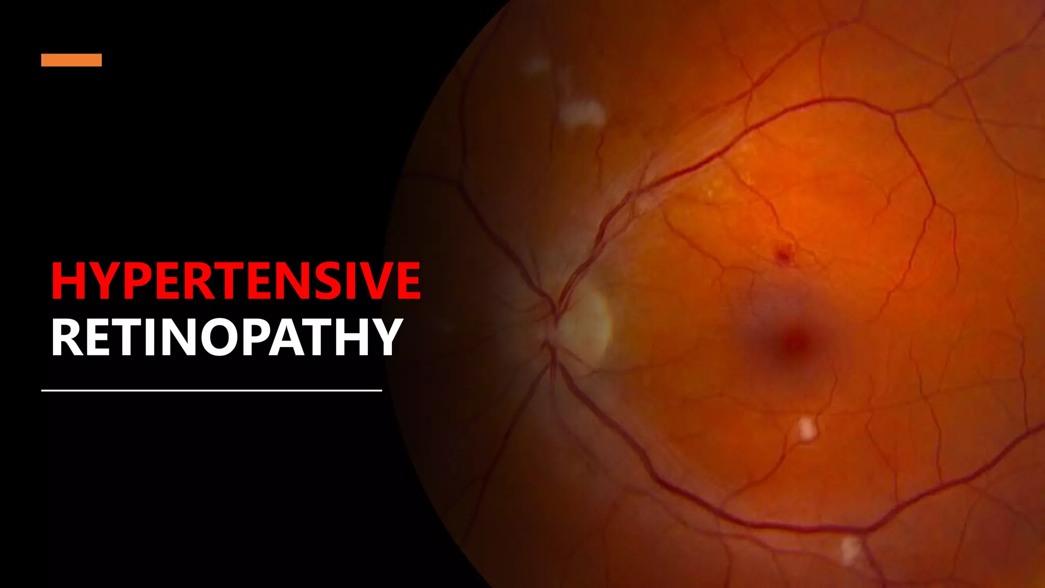 Hypertensive Retinopathy (2).pptx