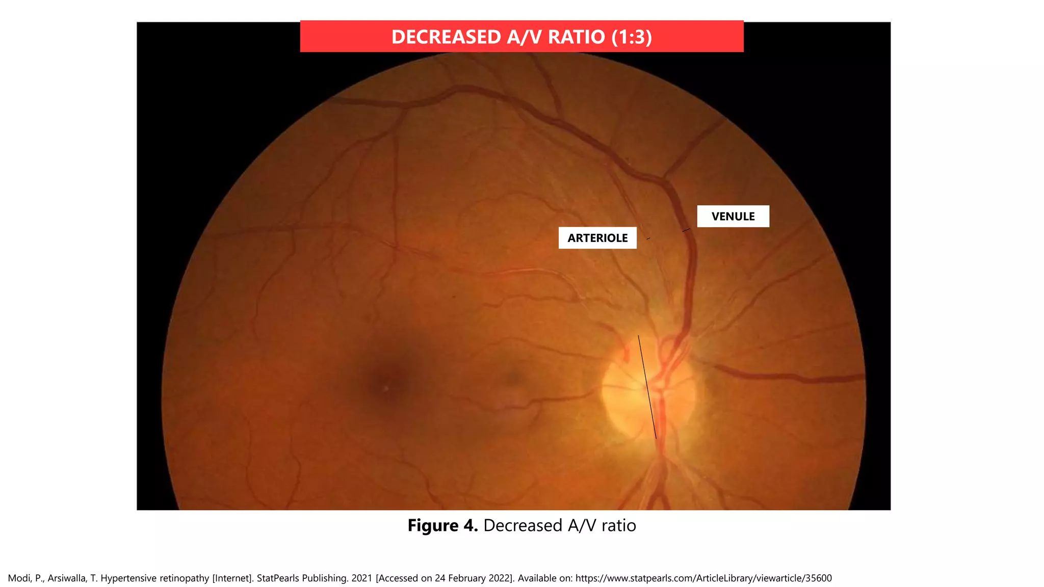 Hypertensive Retinopathy (2).pptx