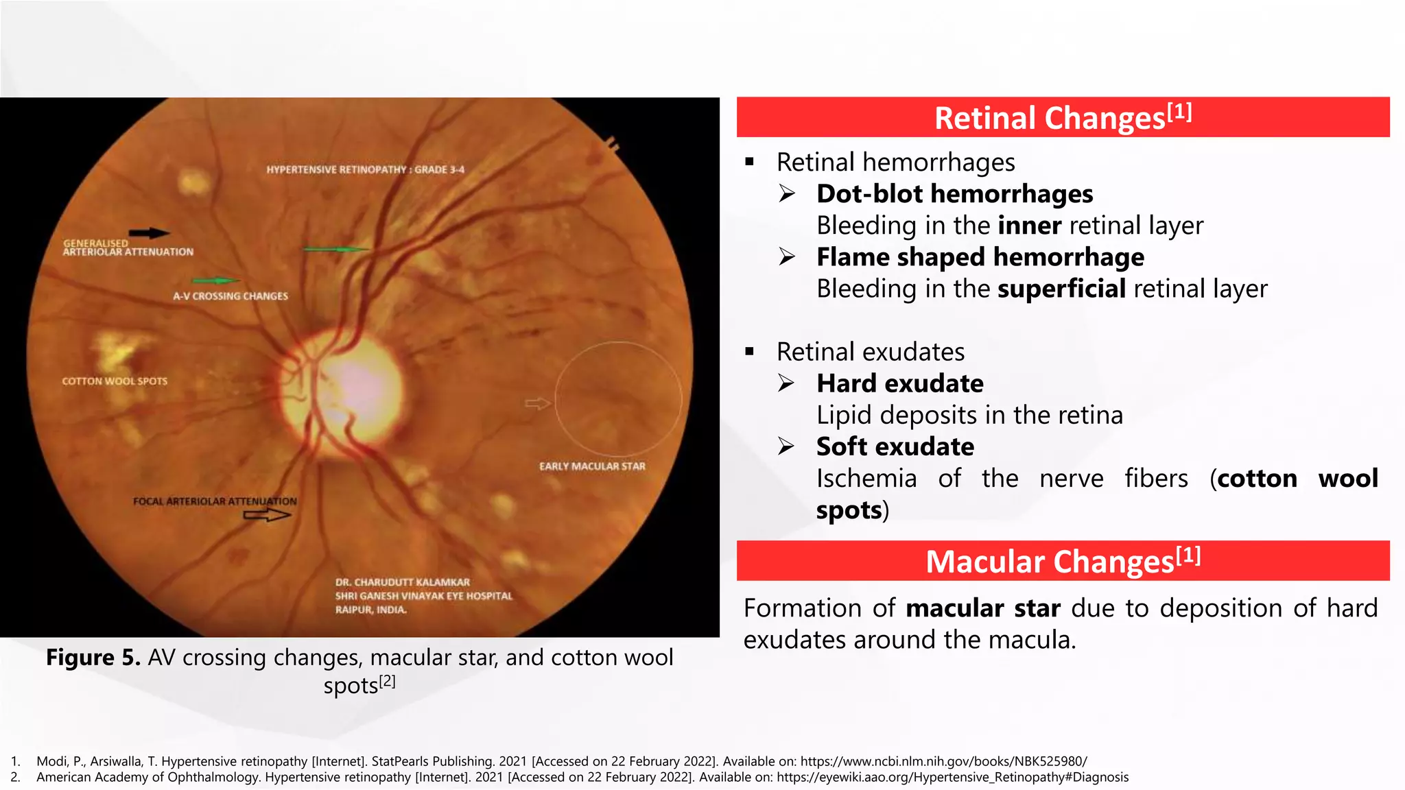 Hypertensive Retinopathy (2).pptx