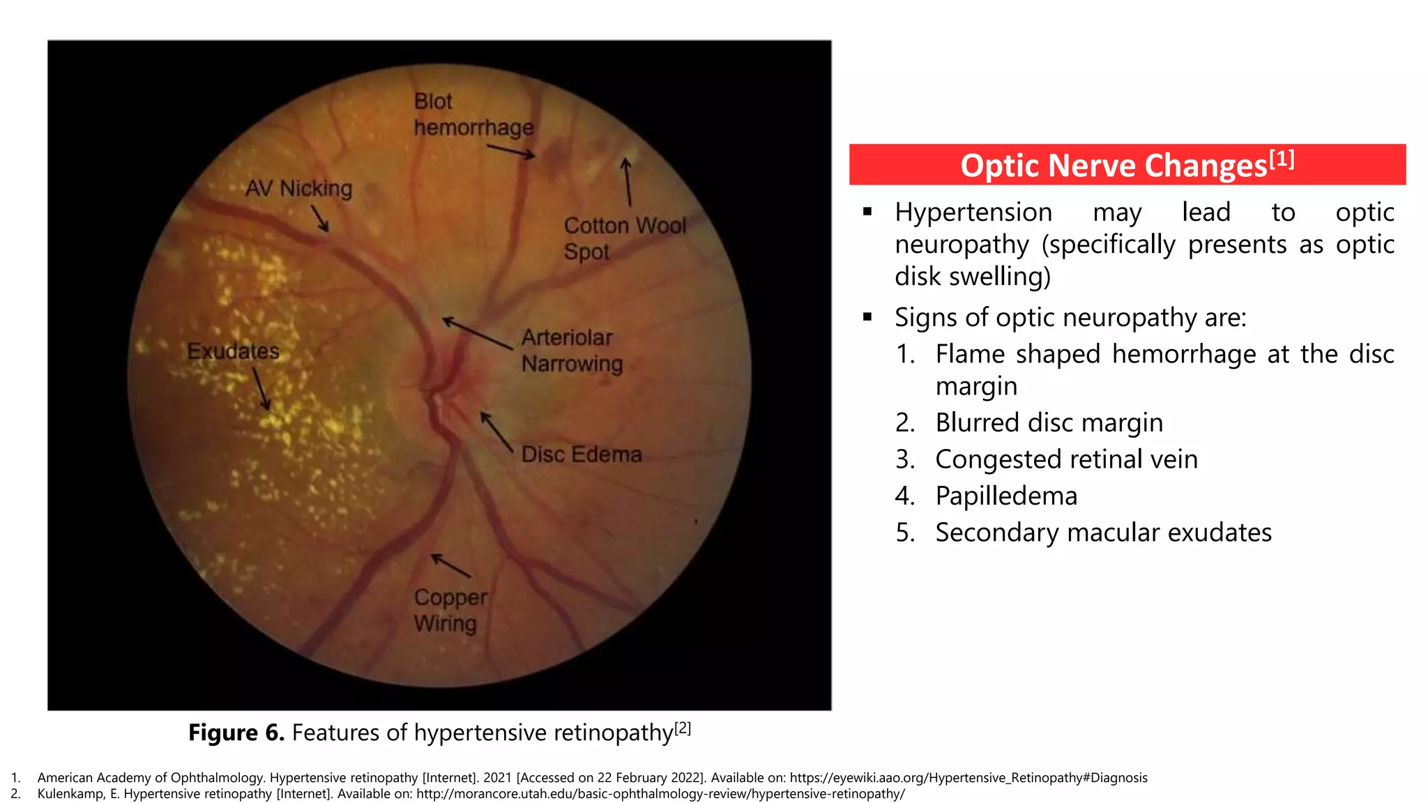Hypertensive Retinopathy (2).pptx
