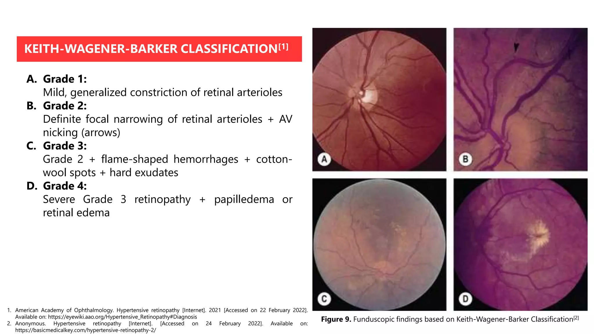 Hypertensive Retinopathy (2).pptx