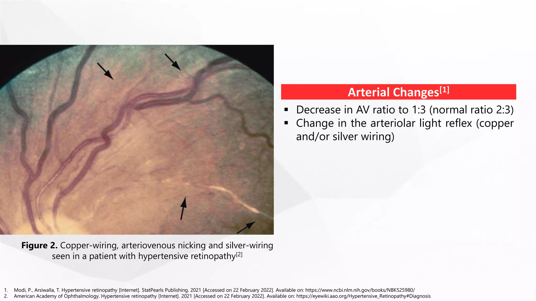 Hypertensive Retinopathy (2).pptx