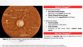 Hypertensive Retinopathy (2).pptx