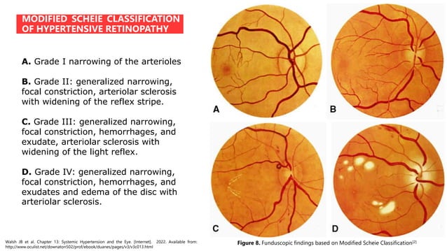 Hypertensive Retinopathy (2).pptx | Eye and Vision Conditions ...