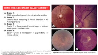 Hypertensive Retinopathy (2).pptx