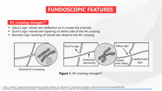 Hypertensive Retinopathy (2).pptx