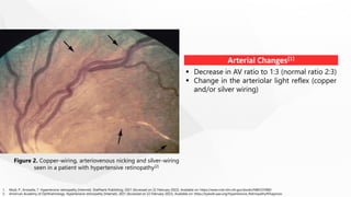 Hypertensive Retinopathy (2).pptx