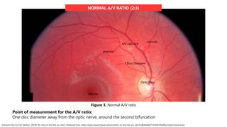 Hypertensive Retinopathy (2).pptx