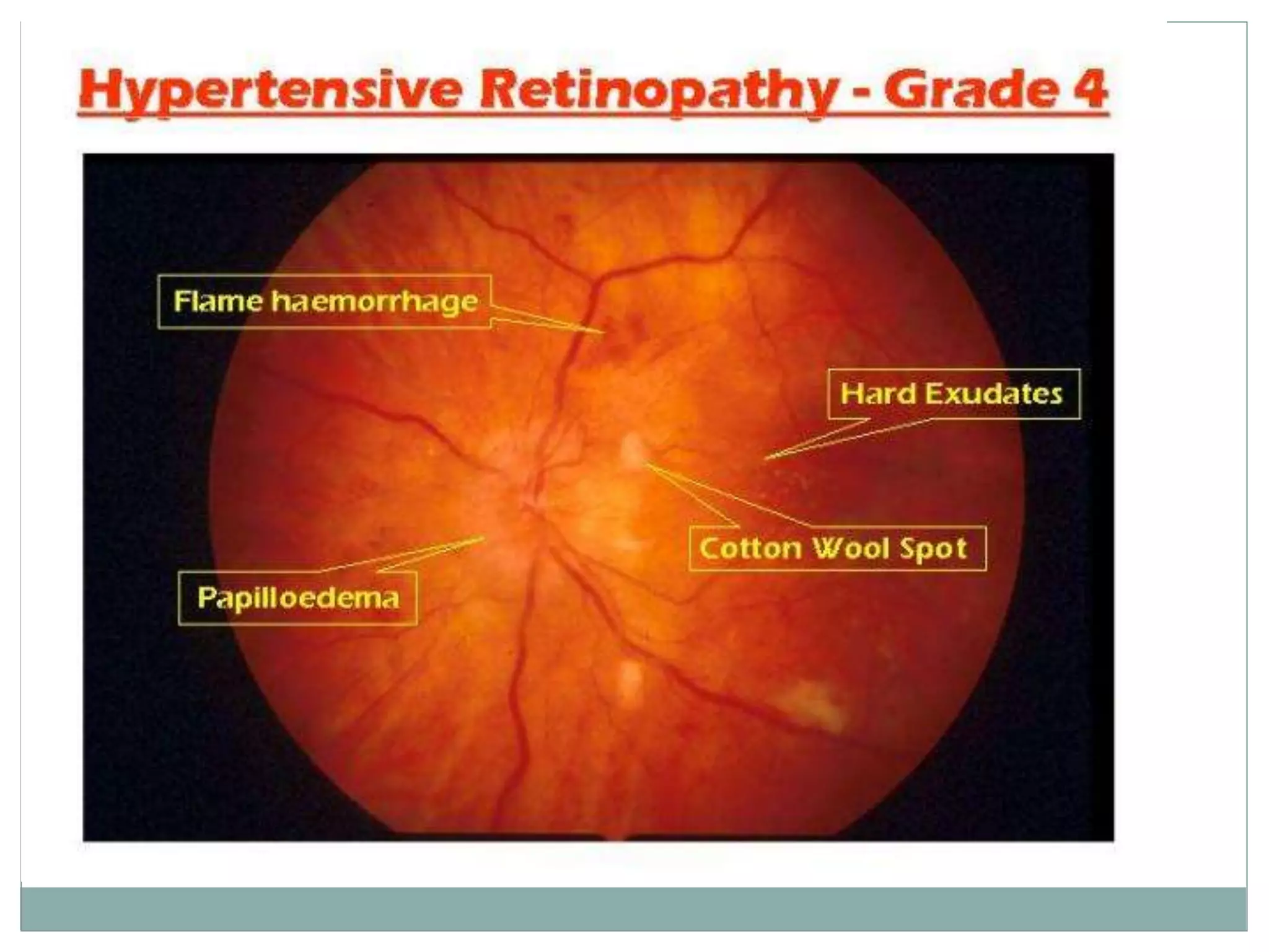 Hypertensive retinopathy and diabetic retinopathy | PPTX