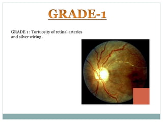 Hypertensive retinopathy and diabetic retinopathy | PPTX