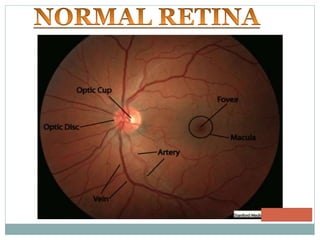 Hypertensive Retinopathy Silver Wiring