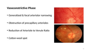 Hypertensive Retinopathy and Retinal Vein Occlusion -Dr. Prabhat ...