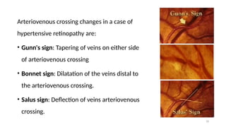Hypertensive Retinopathy and Retinal Vein Occlusion -Dr. Prabhat ...