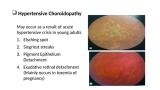 Hypertensive Retinopathy and Retinal Vein Occlusion -Dr. Prabhat ...