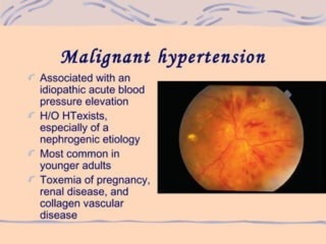 Hypertensive retinopathy presentation ppt | PPT