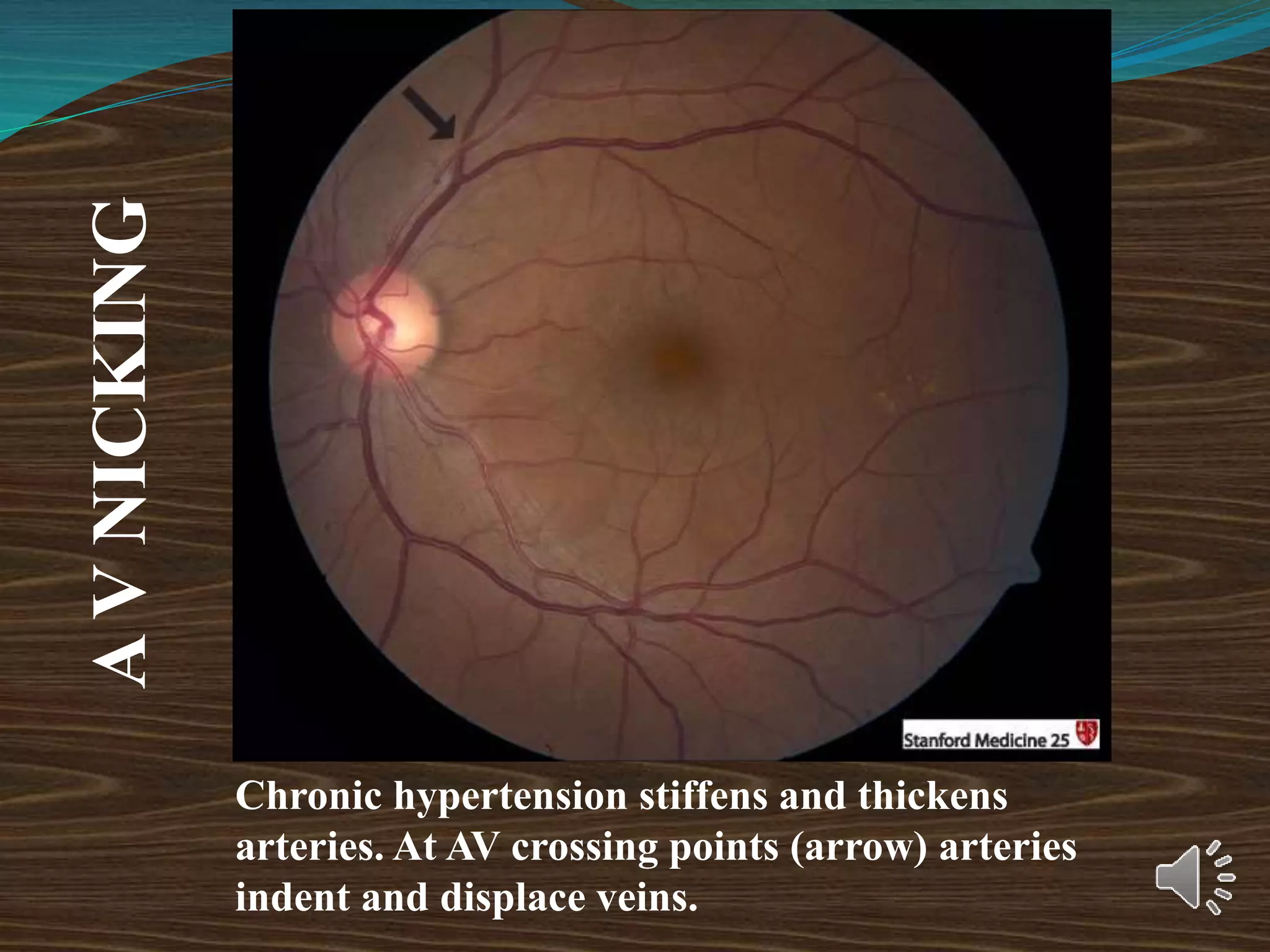 Hypertensive Retinopaty.ppt