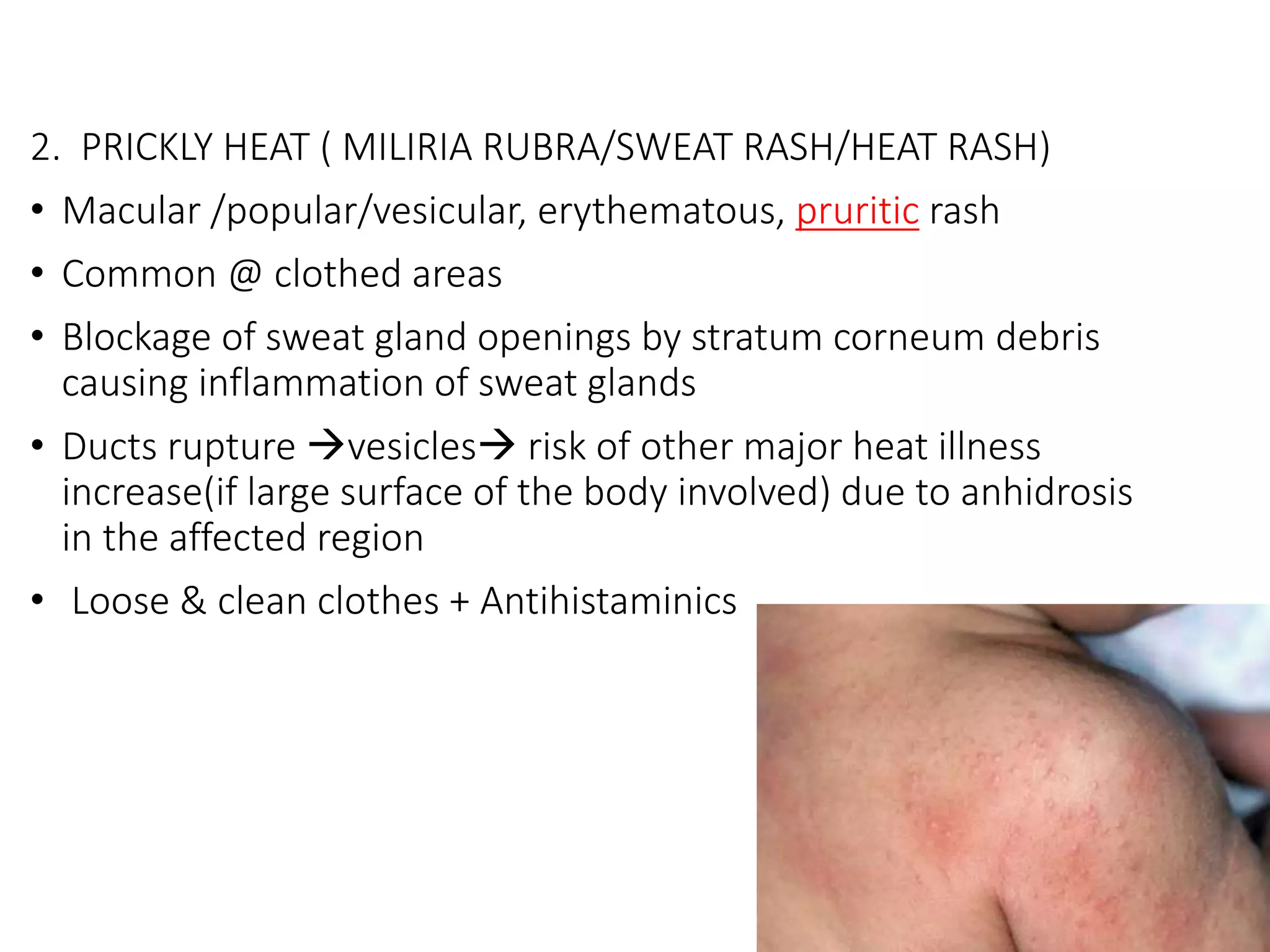 Hyperthermia and heat stroke | PPTX