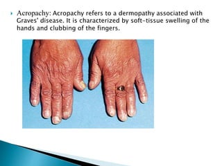 Hyperthyrodism | PPTX