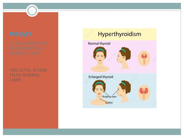 Hyperthyroide | PPT