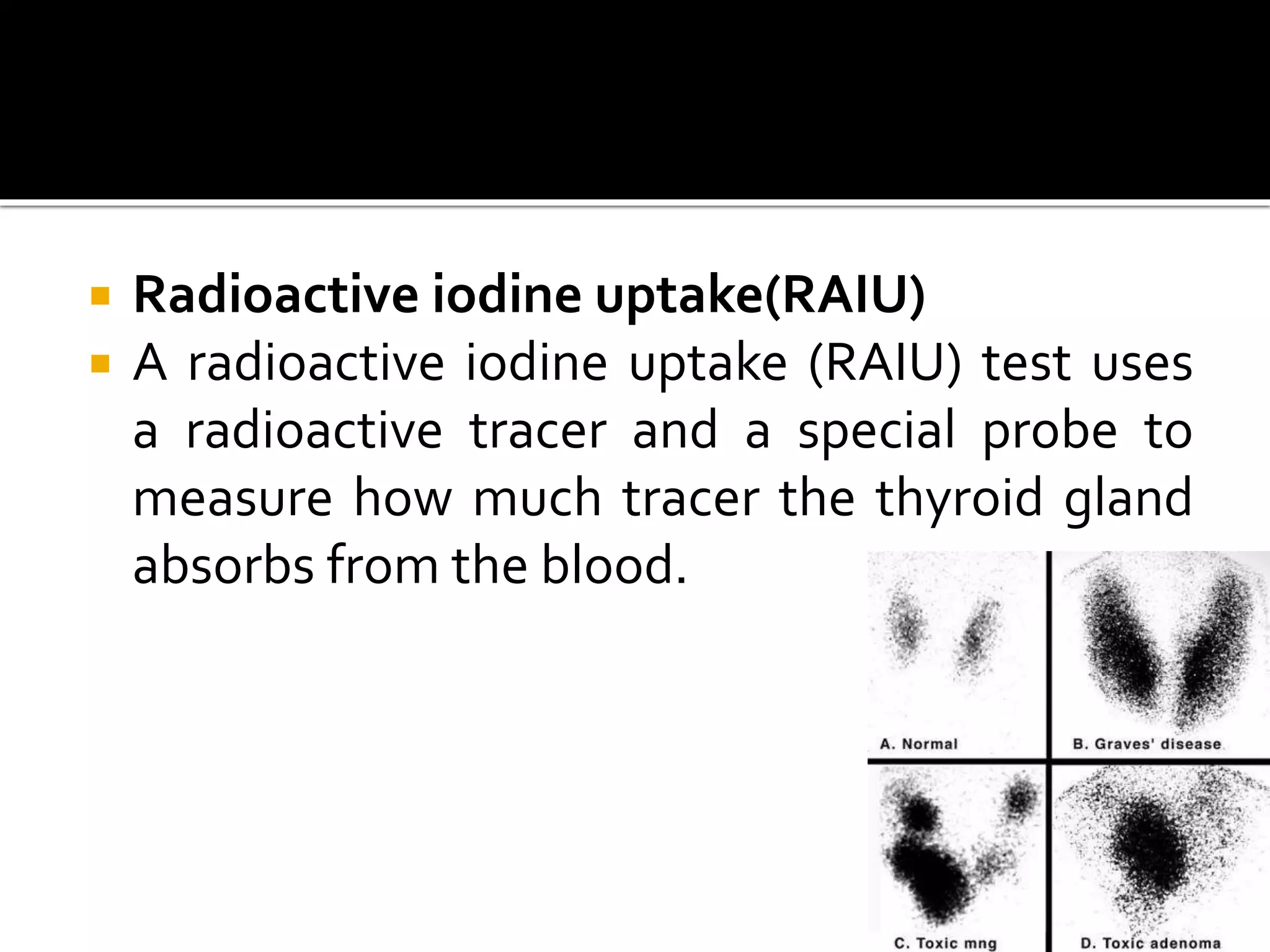 Hyperthyroidism | PPTX
