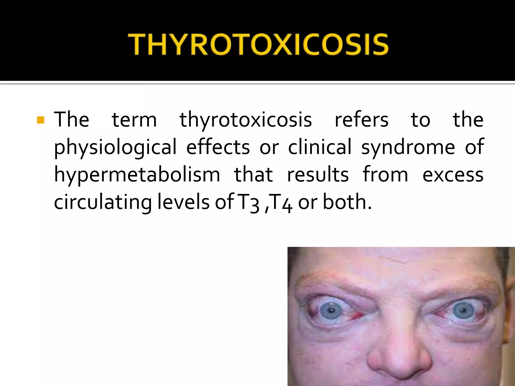 Hyperthyroidism | PPTX