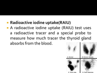 Hyperthyroidism | PPTX