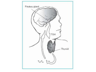 Hyperthyroidism | PPT