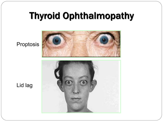 hyperthyroidism-180209201848.pdf