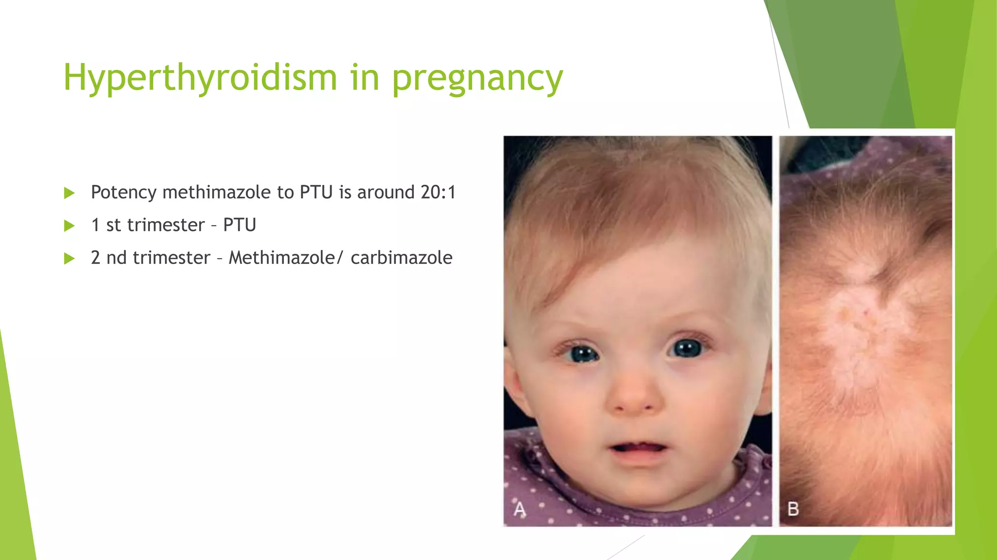 Hyperthyroidism | PPTX