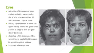 Hyperthyroidism | PPTX