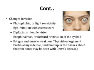 Hyperthyroidism | PPTX