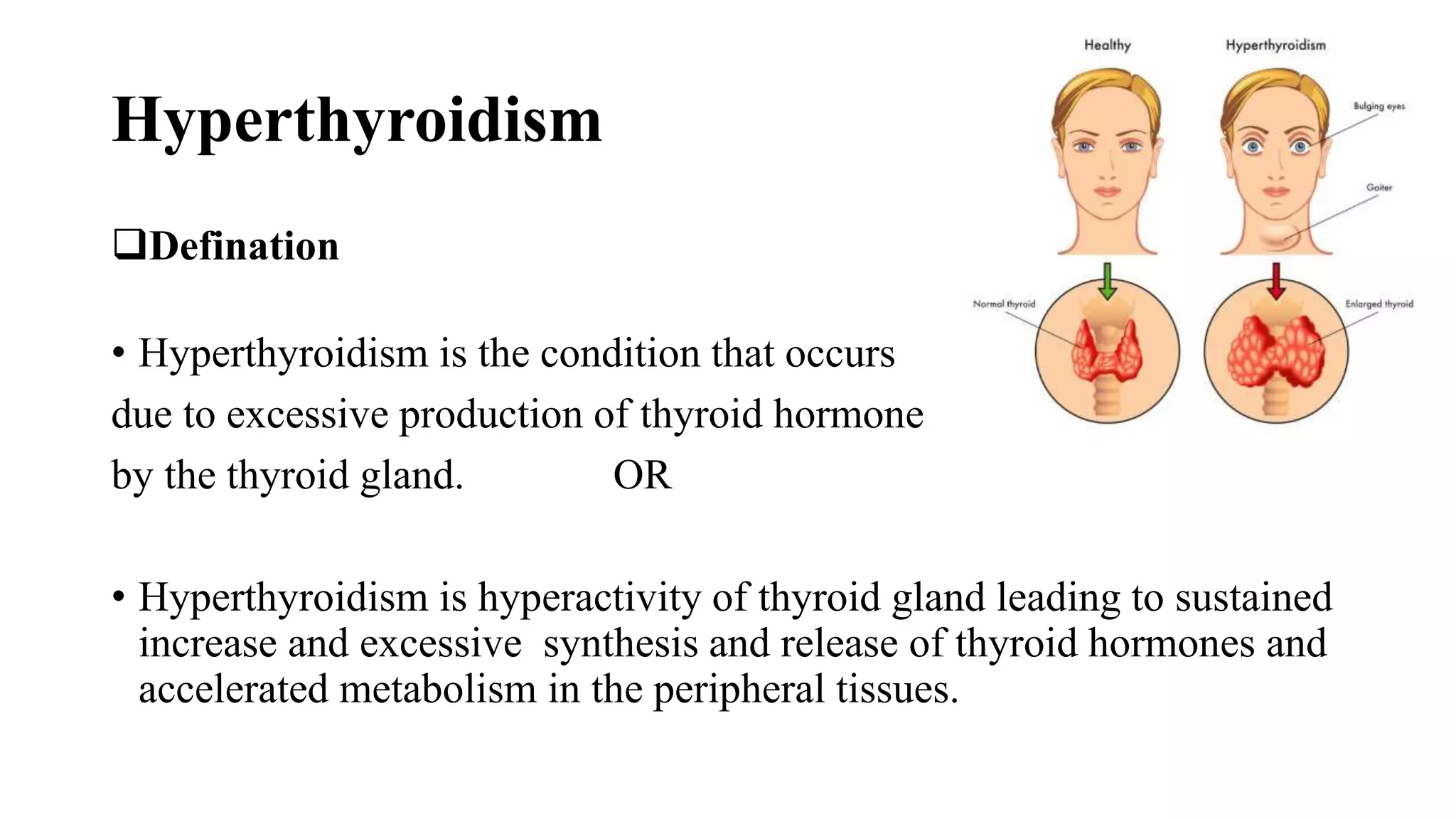 Hyperthyroidism | PPTX