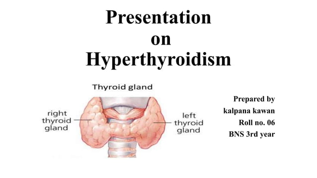 Hyperthyroidism | PPTX