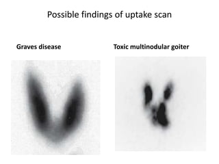 Hyperthyroidism.pptx