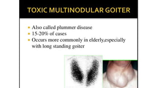 Hyperthyroidism thyroid disorders .pptx