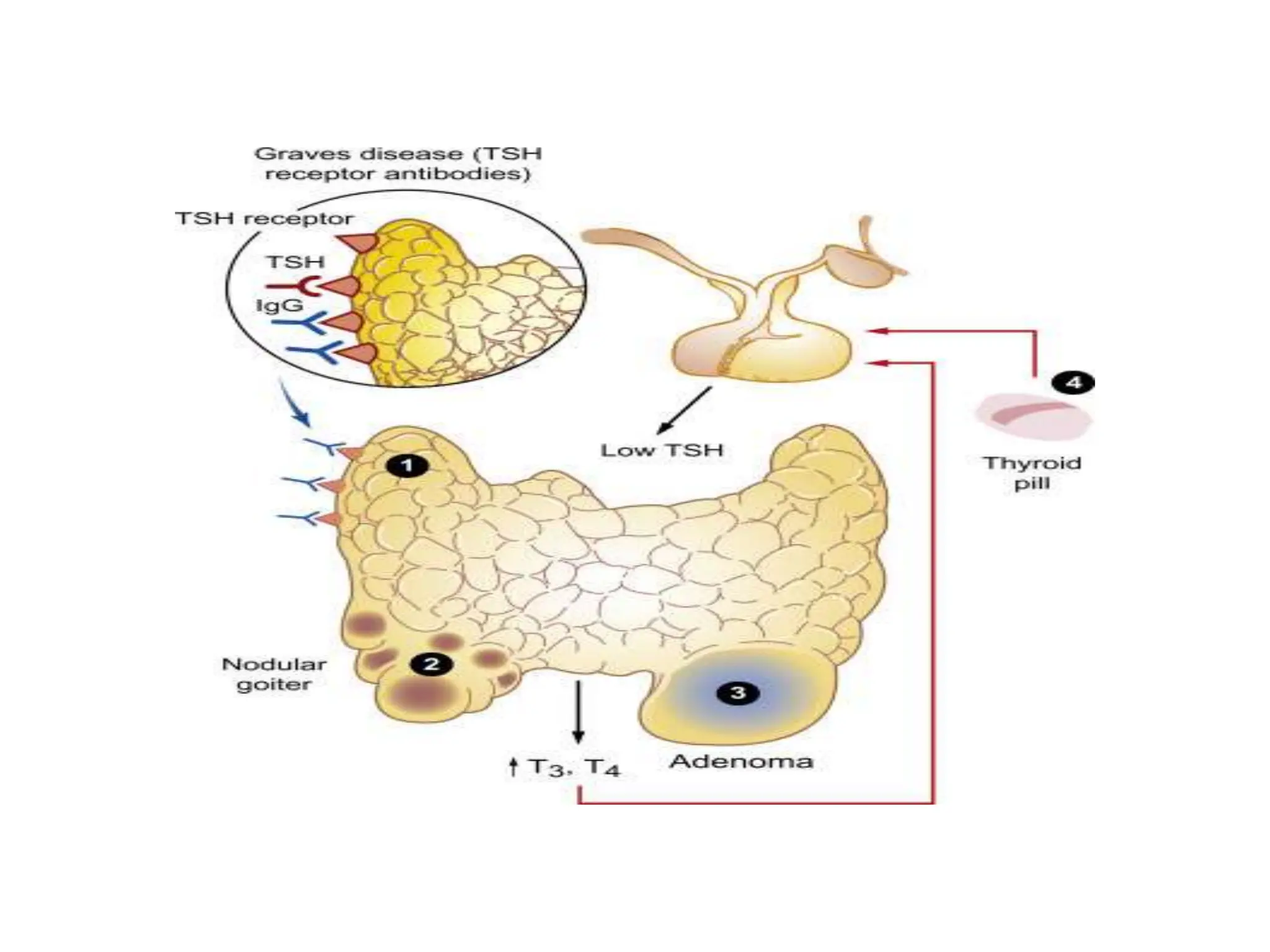 HYPERTHYROIDISM,clinical features and its management | PPT