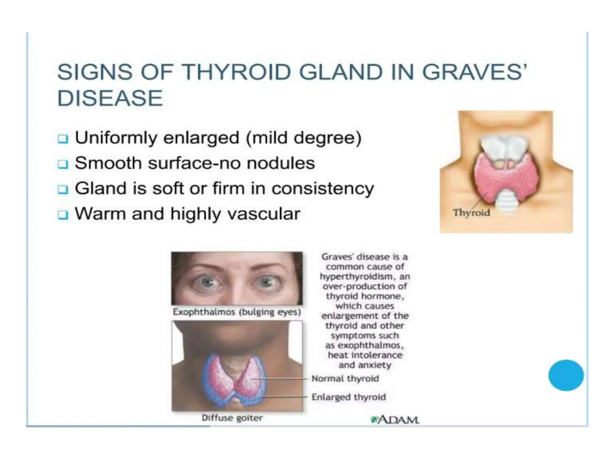 HYPERTHYROIDISM,clinical features and its management | PPT