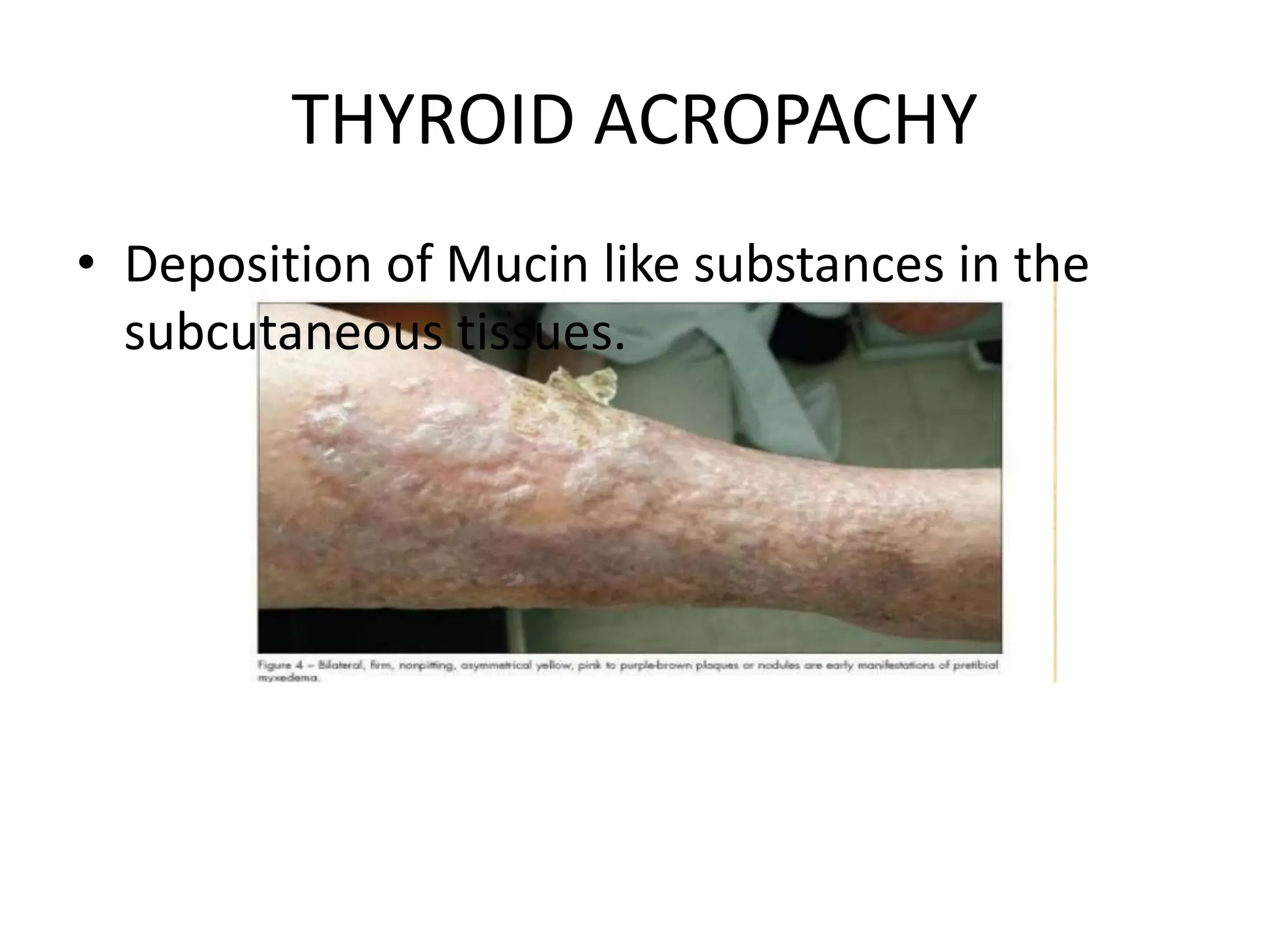 HYPERTHYROIDISM,clinical features and its management | PPTX