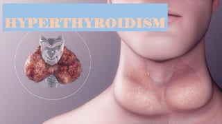 thyroid disorder hyperthyroidism disorder.pptx