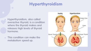 hyperthyroidism .pptx