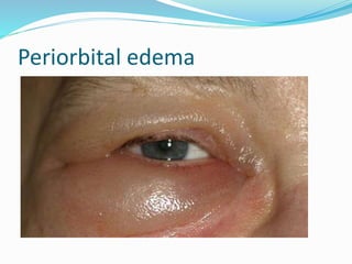 Hyperthyroidism | PPTX