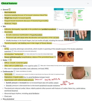 Hyperthyroidism and thyrotoxicosis - AMBOSS.pdf