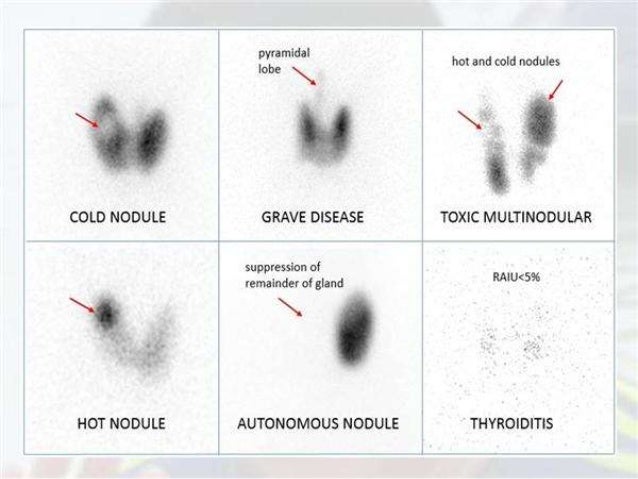 HYPERTHYROIDISM PART-1 BY DR BASHIR ASSOCIATE PROFESSOR MEDICINE SOPO…