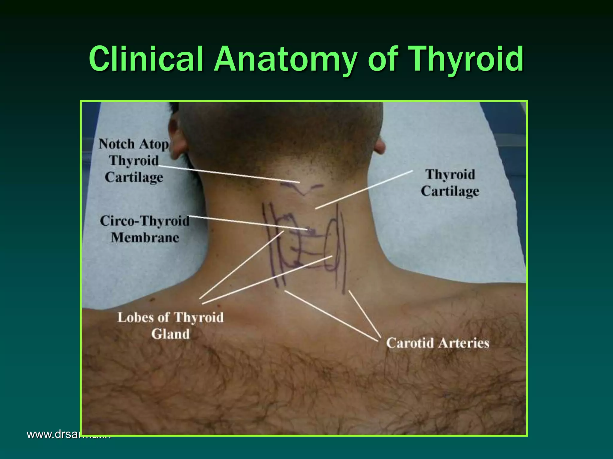Hyperthyroidism for Apex students.ppt