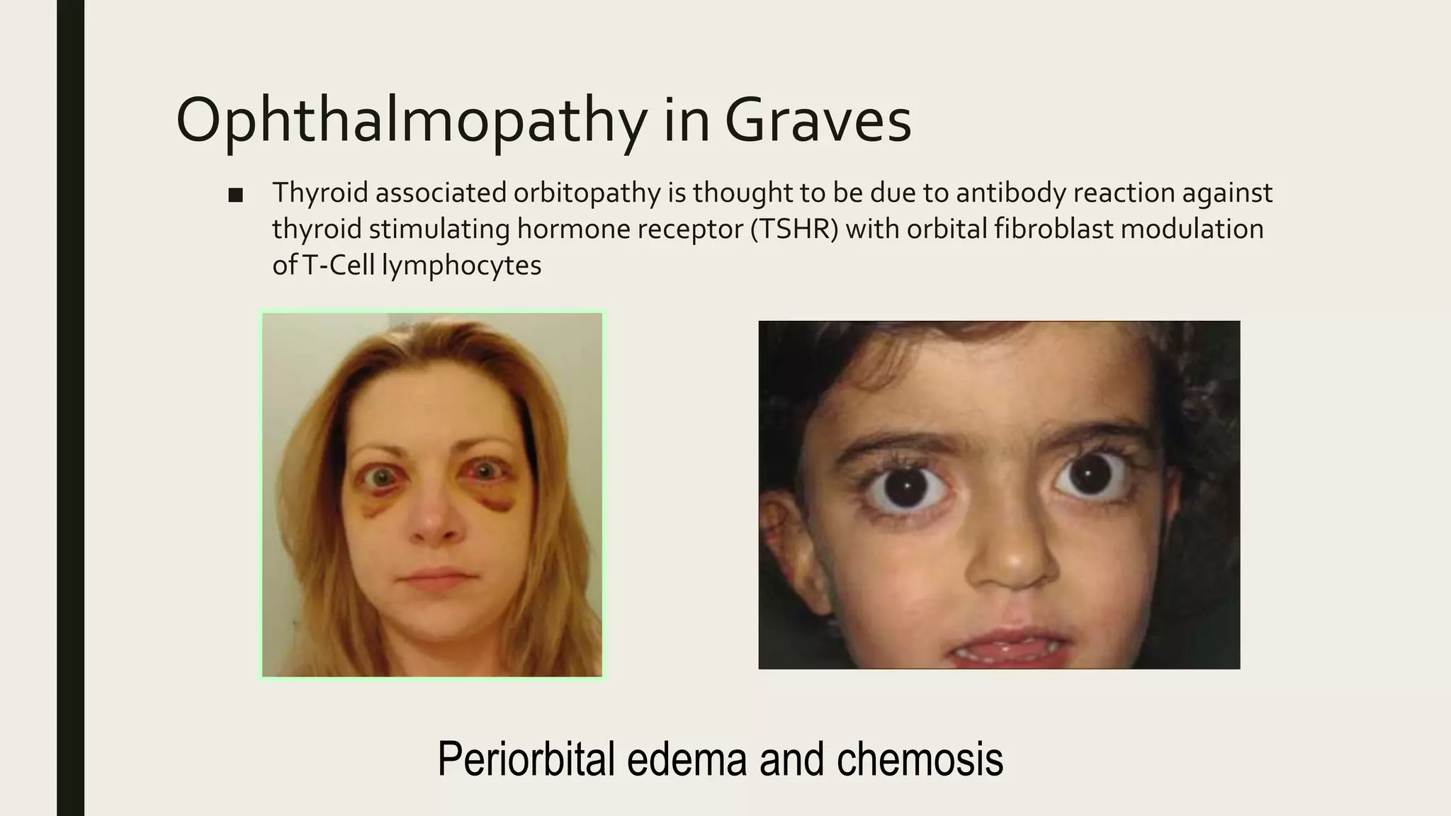Hyperthyroidism in children | PPTX