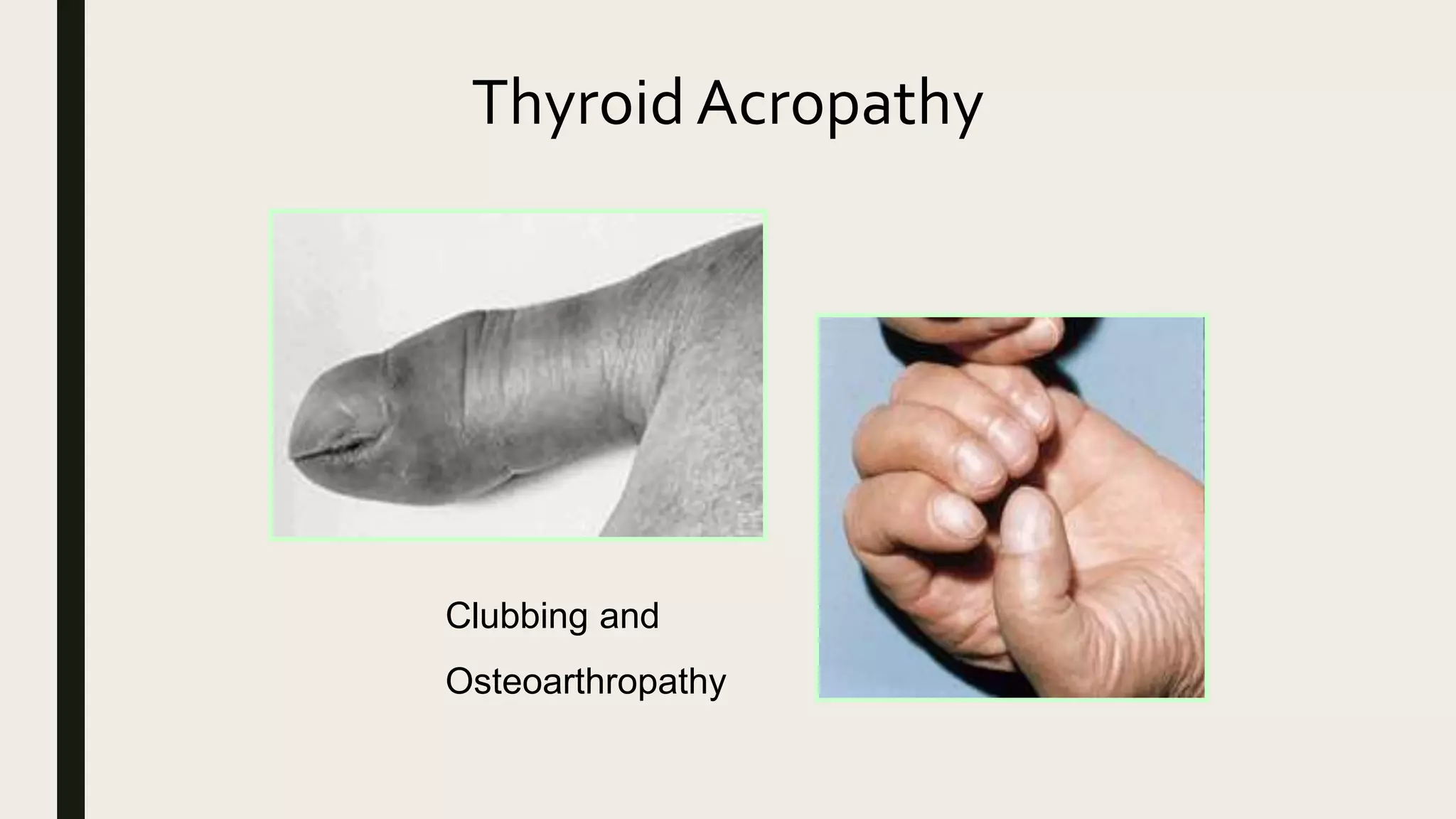 Hyperthyroidism in children | PPTX
