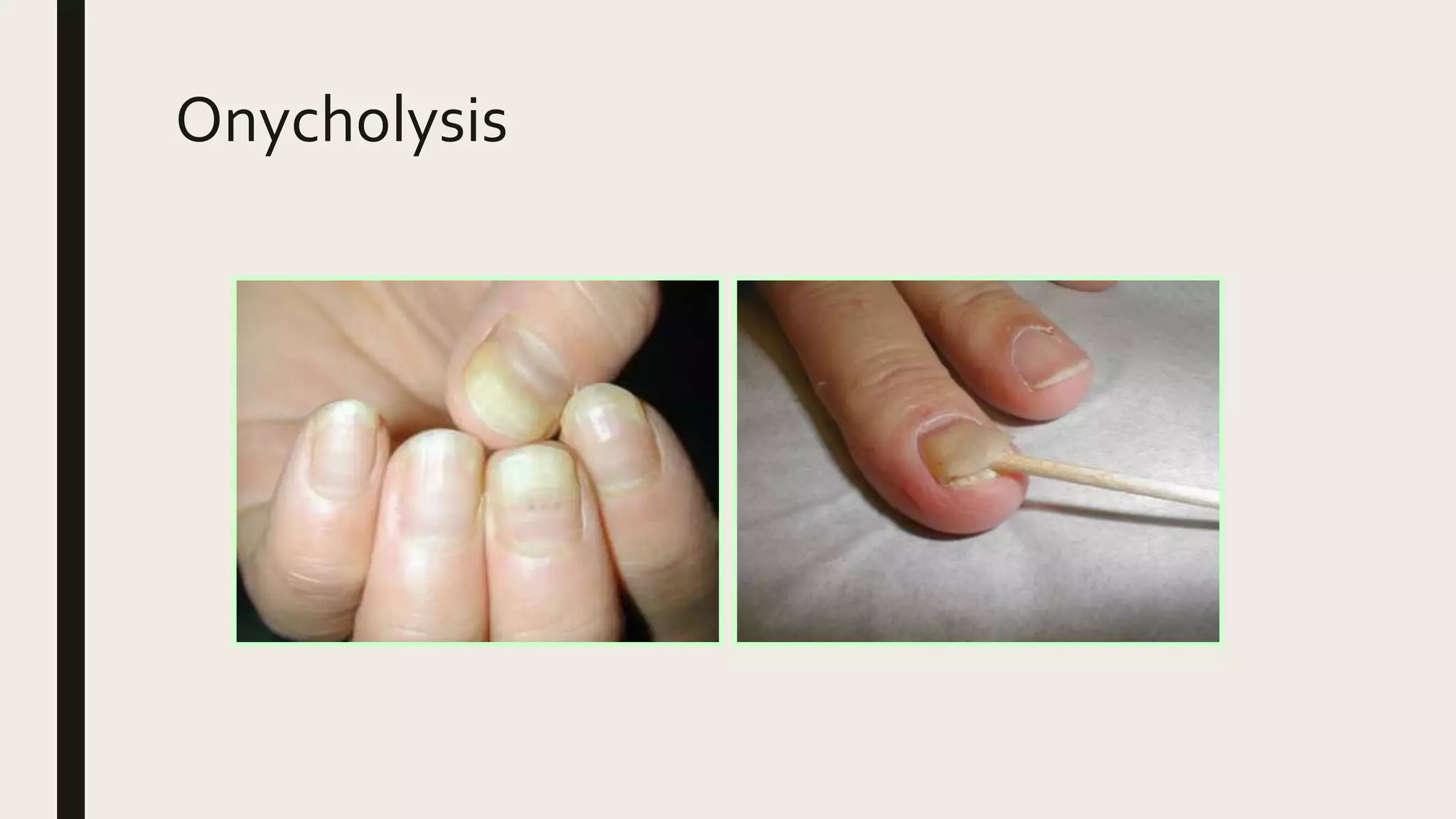 Hyperthyroidism in children | PPTX