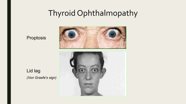 Hyperthyroidism in children | PPTX | Thyroid Disorders | Endocrine and ...