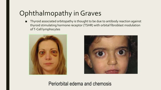 Hyperthyroidism in children | PPTX | Thyroid Disorders | Endocrine and ...